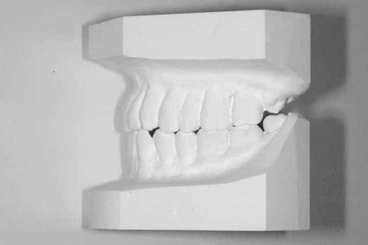 Cas classe III (prognathe)