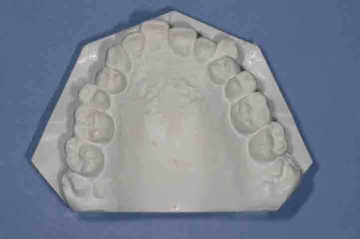 Cas classe III (prognathe)