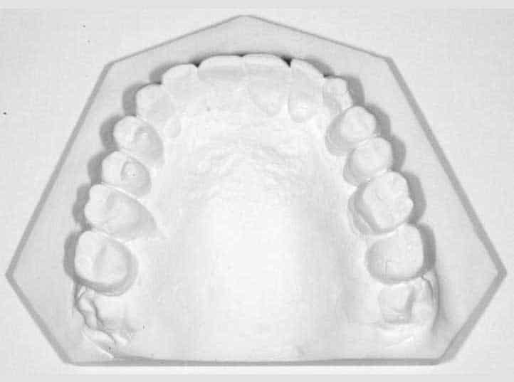 Cas classe III (prognathe)